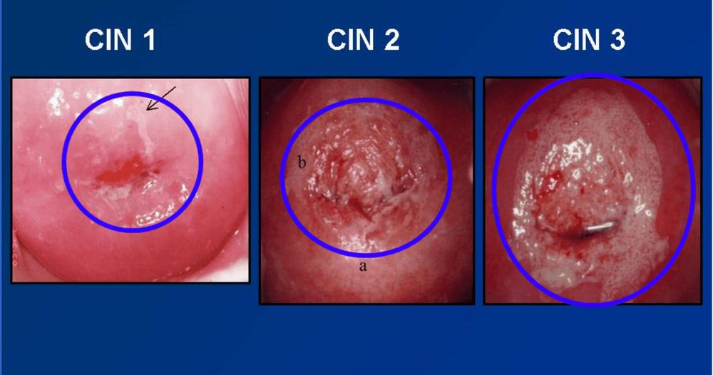 Thế nào là tổn thương nội biểu mô cổ tử cung (CIN)?
